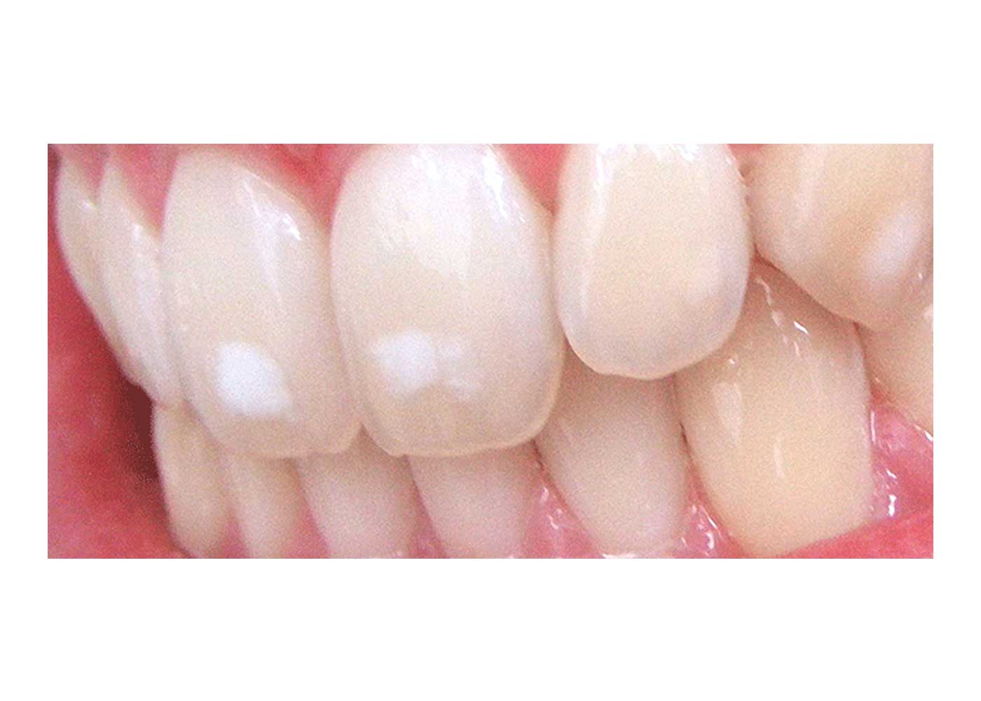 Why Smile Makeovers Are the Best Solution for Your Faded Teeth